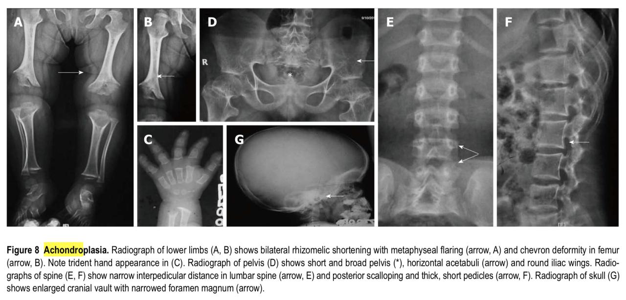 ACHONDROPLASIA-SHORT STATURE-DWARFISM – radiologi.id